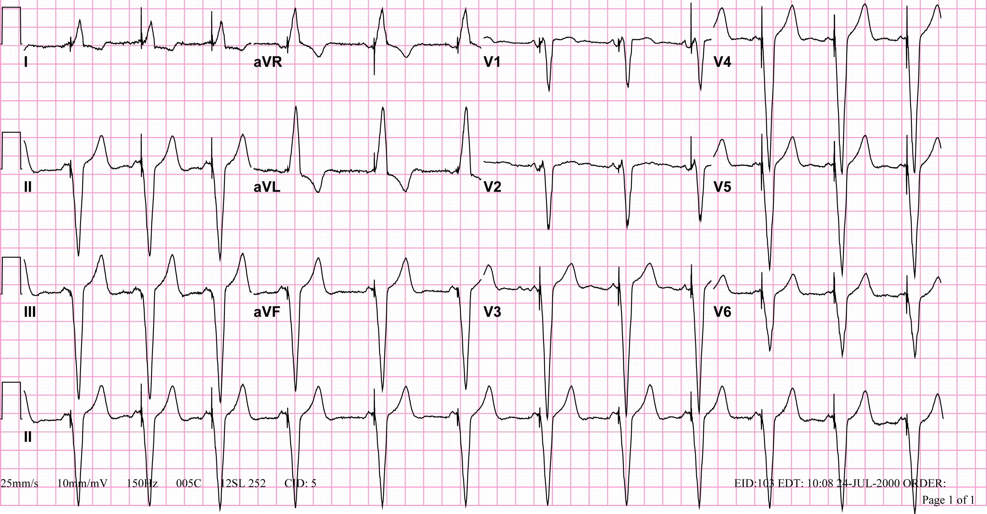 File A sense v pace ecg jpg WikEM File A sense v pace ecg jpg WikEM